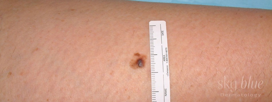 Melanoma Detection - Sky Blue Dermatology