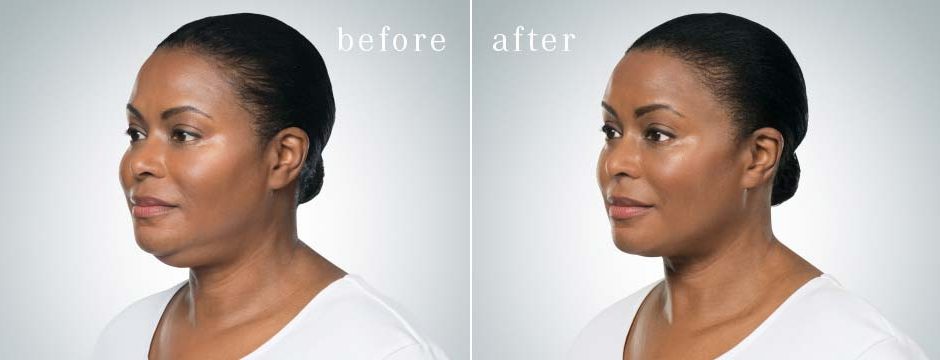 Fat dissolving treatments - Sky Blue Dermatology