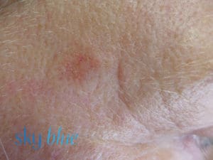 Skin Cancer – What you need to know (and a bit more) | Sky Blue Dermatology