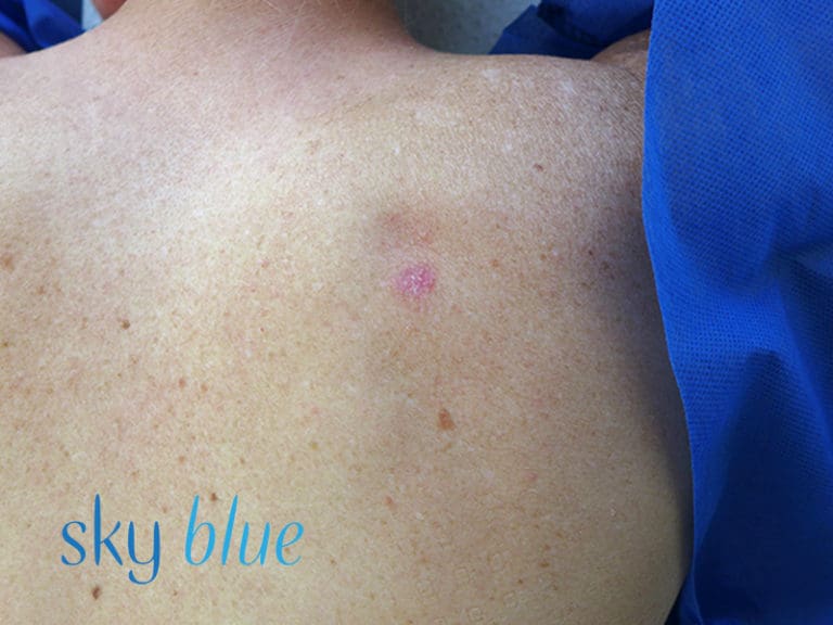 Skin Cancer – What you need to know (and a bit more) | Sky Blue Dermatology