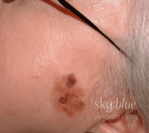 A Dermatologist’s short guide to (facial) pigmentation | Sky Blue ...