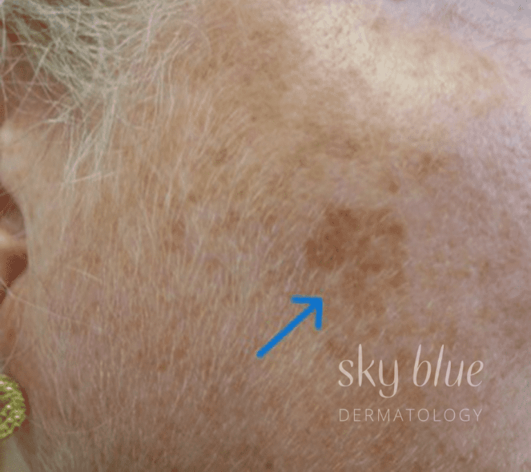 A Dermatologist’s short guide to (facial) pigmentation | Sky Blue ...